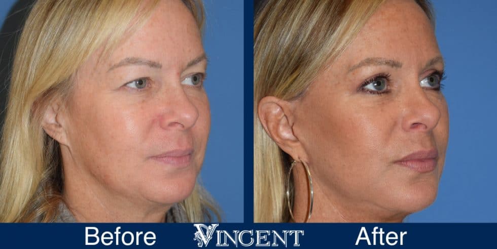 Facelift Before and After Photos - Vincent Surgical Arts & Medspa