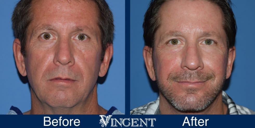 Facelift Before and After Photos - Vincent Surgical Arts & Medspa