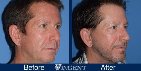 Facelift Before and After Photos - Vincent Surgical Arts & Medspa