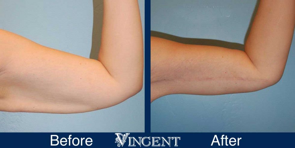View Our Brachioplasty Photo Gallery | Vincent Surgical Arts in Utah