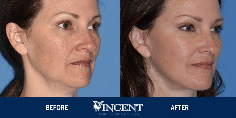 Facelift Before and After Photos - Vincent Surgical Arts & Medspa